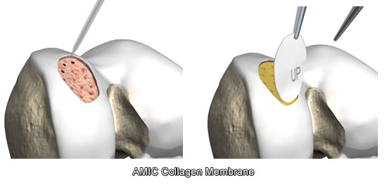 Knee Treatments | Northampton Orthopaedics Surgery & Sports Injuries