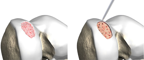 Knee Treatments | Northampton Orthopaedics Surgery & Sports Injuries